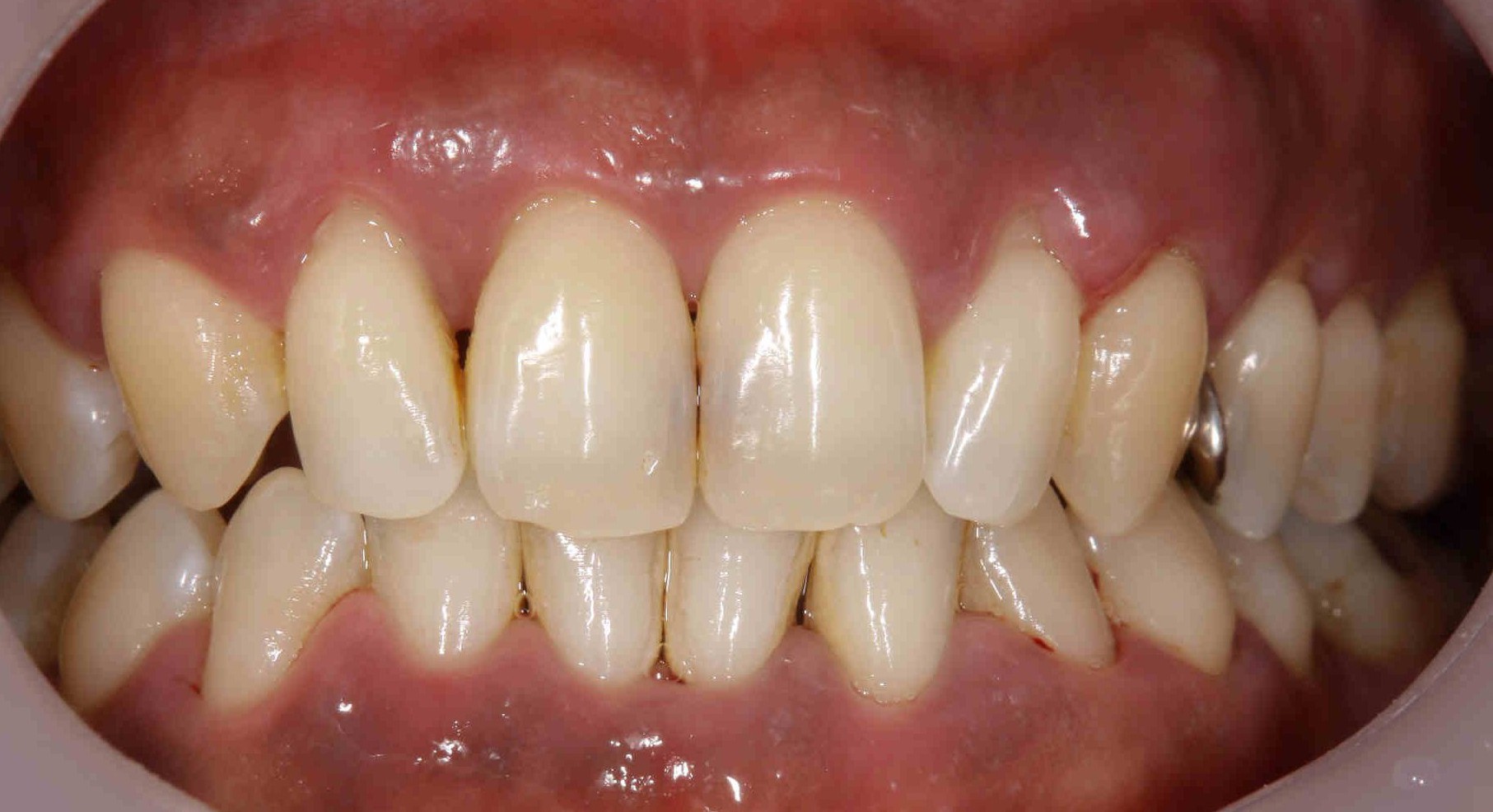 C181-e1402499050504 – TZデンタルクリニック